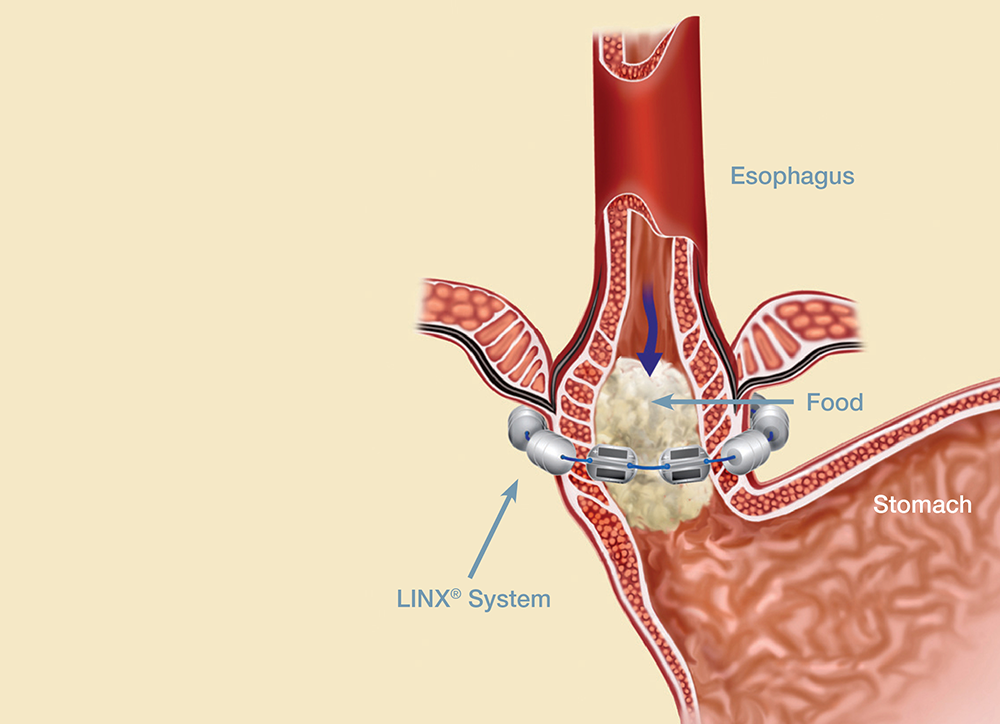 Mit magnetischen Titankugeln die Speiseröhre im Griff | inpactmedia.com